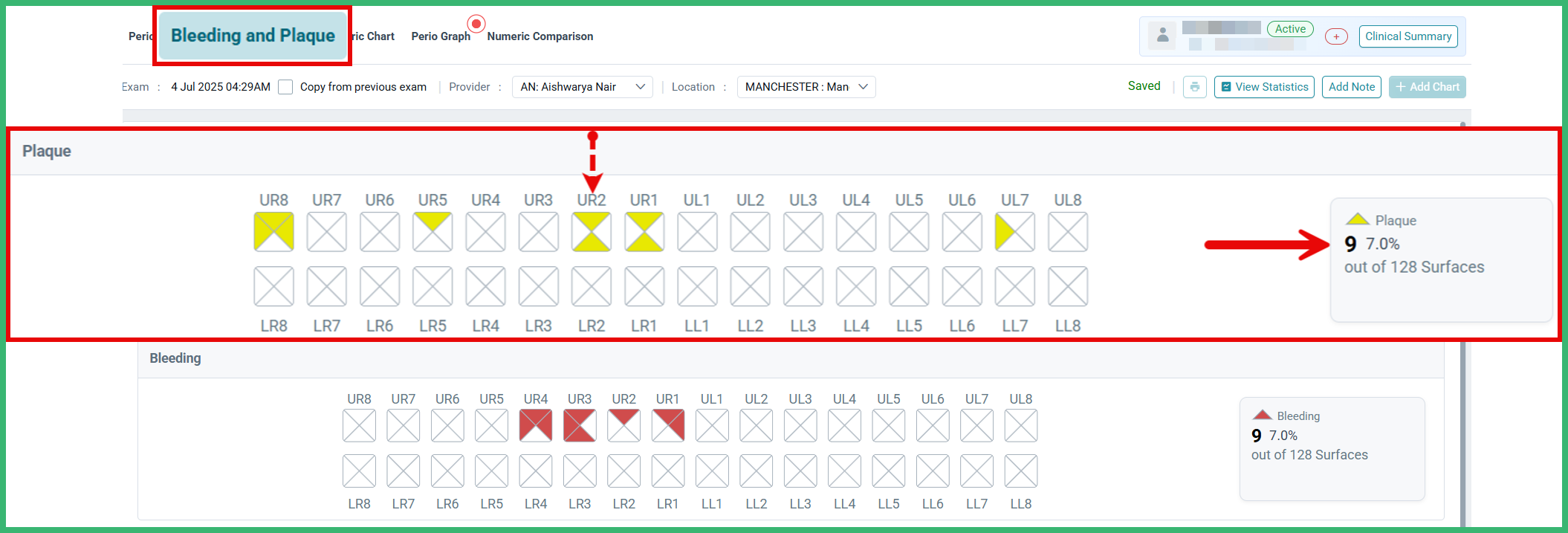Add Plaque and Bleeding to the Perio Chart – CareStack