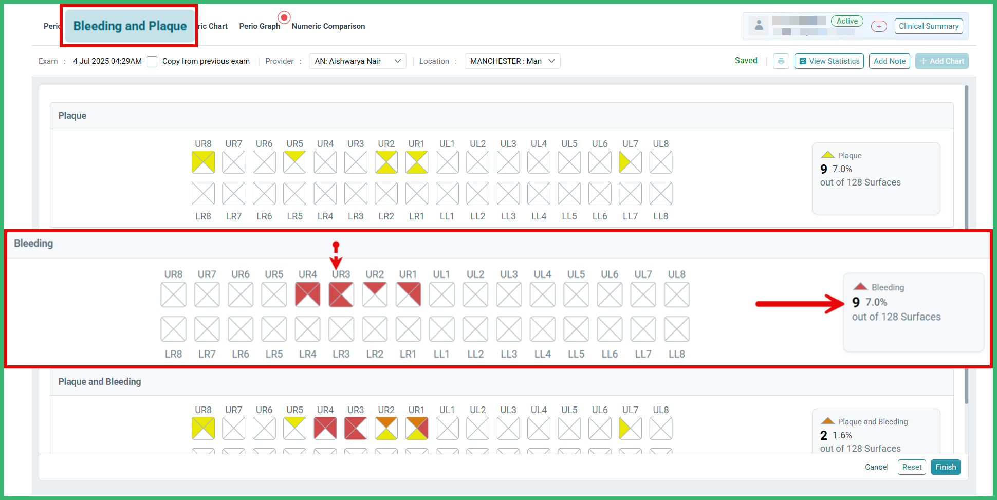Add Plaque and Bleeding to the Perio Chart – CareStack
