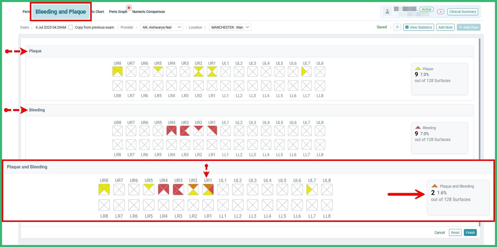 Add Plaque and Bleeding to the Perio Chart – CareStack
